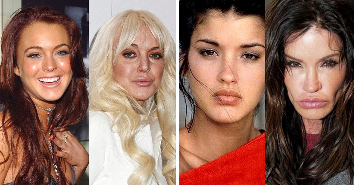17 famosos que se destrozaron la cara gracias a una operación